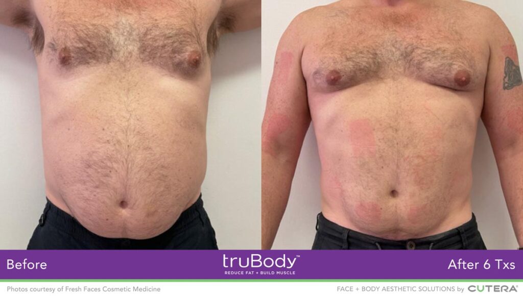 Body Sculpting Treatments » truBody » Lawrenceville, GA