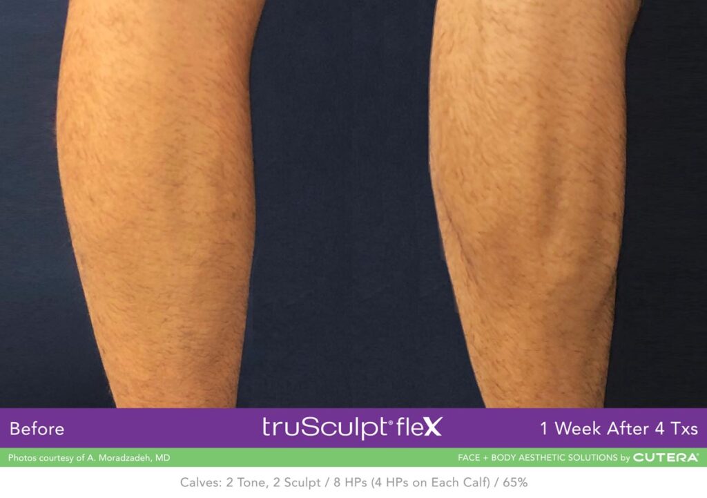 Muscle Sculpting » truSculpt Flex » Lawrenceville, GA